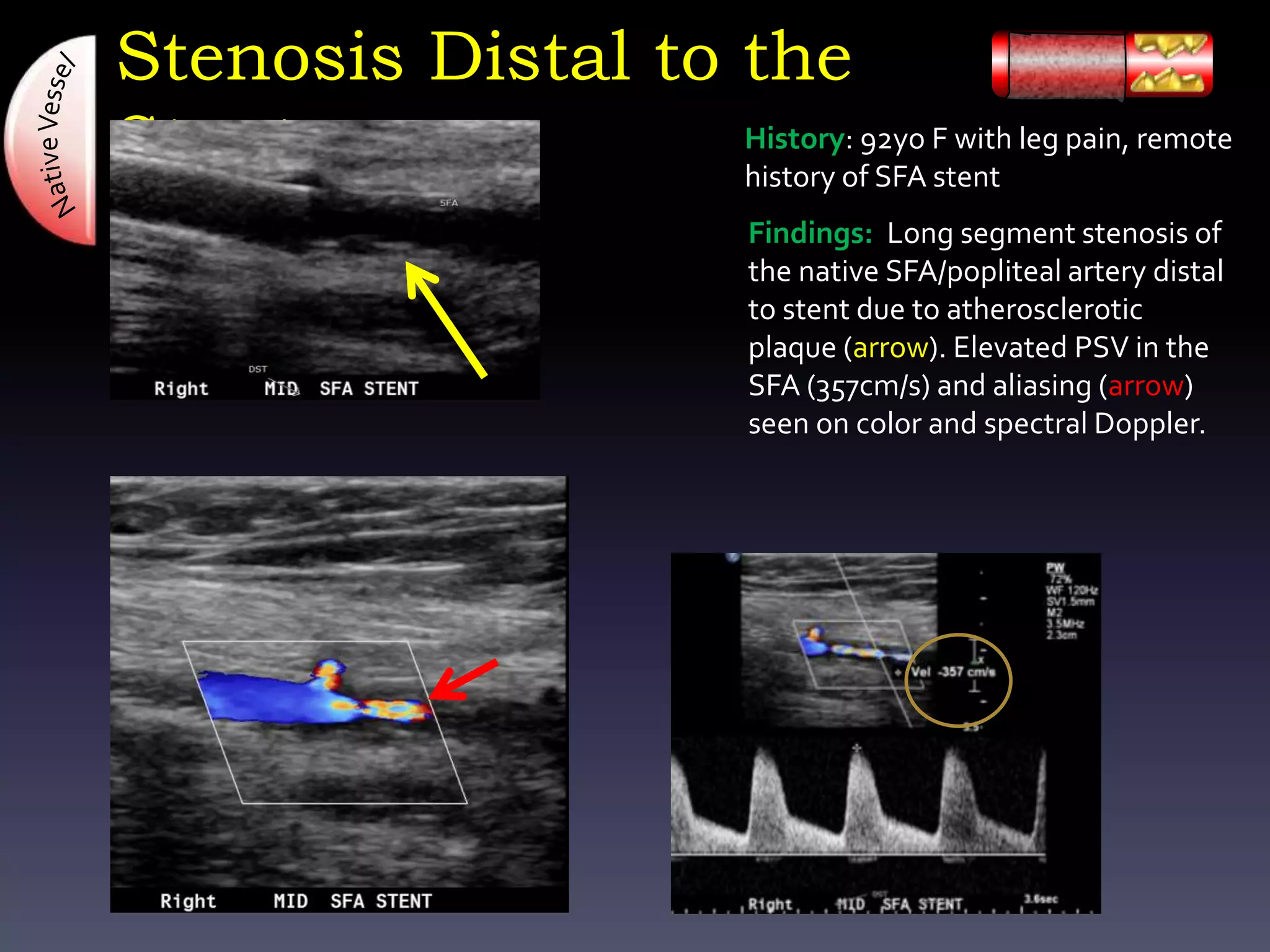 Ultrasound: Arterial Stent Complications by Ali Mian - Yale University ...