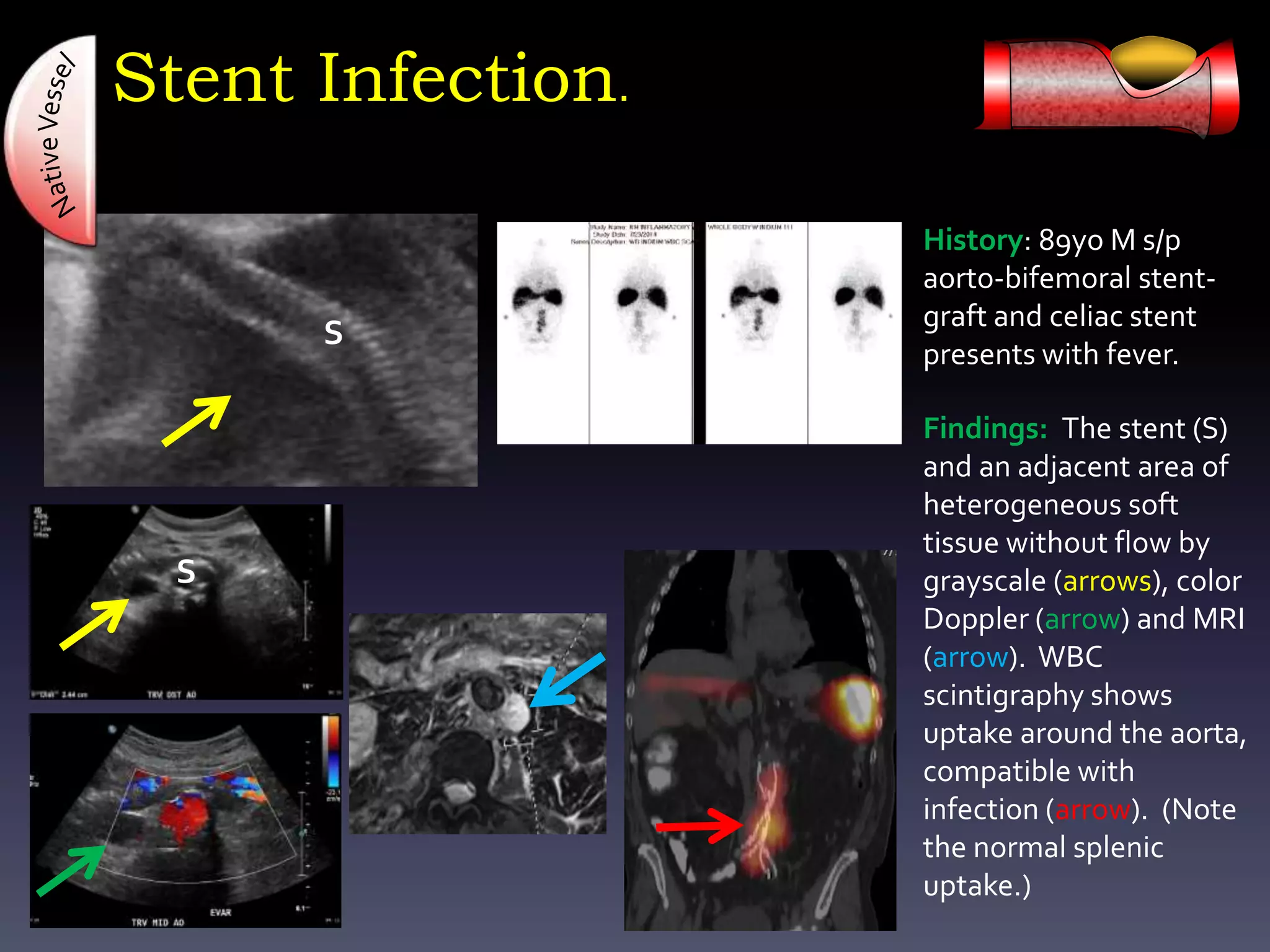 Ultrasound: Arterial Stent Complications by Ali Mian - Yale University ...