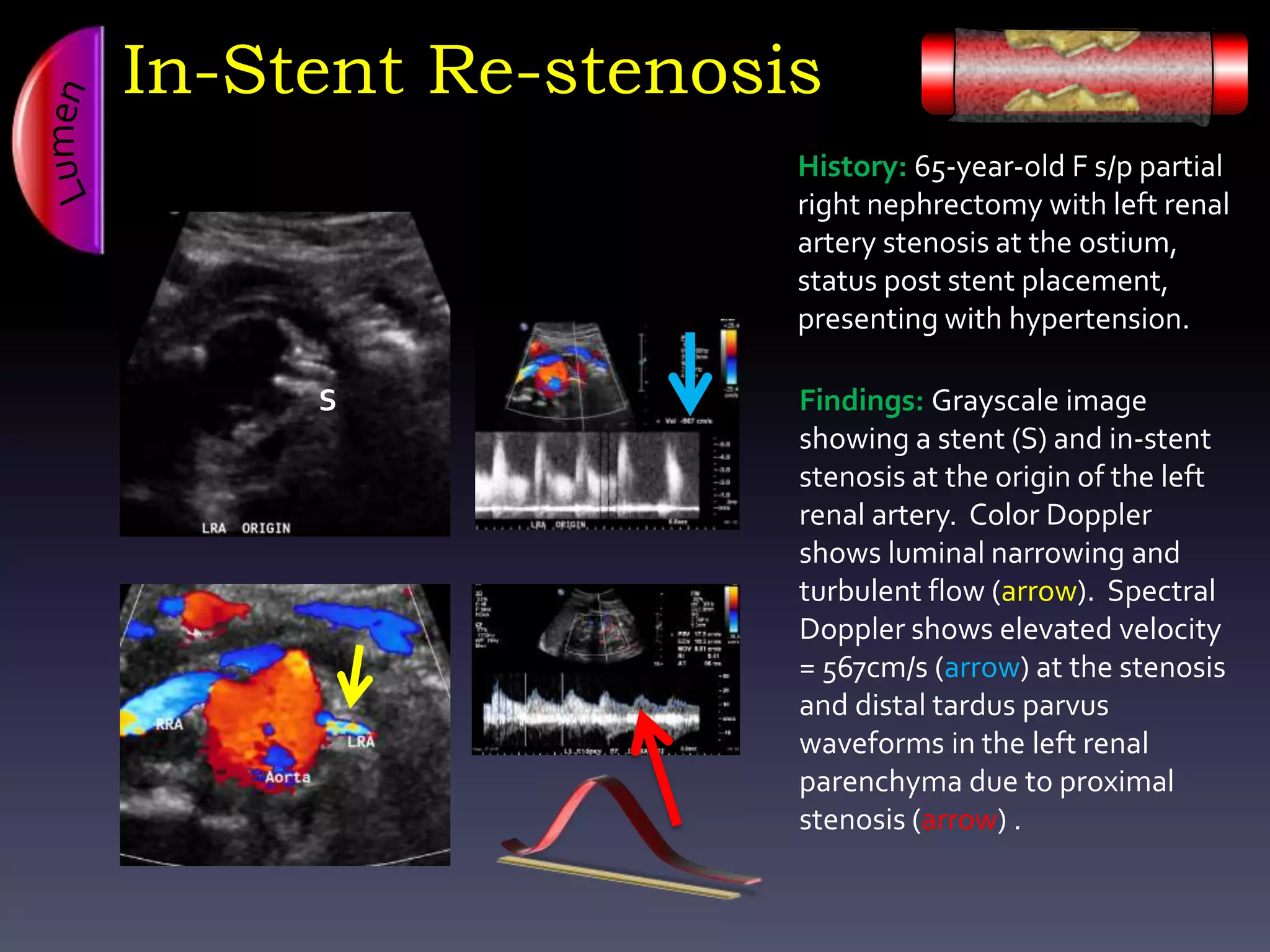 Ultrasound: Arterial Stent Complications by Ali Mian - Yale University ...