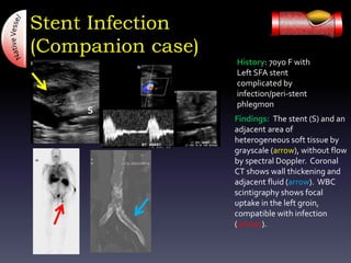 Ultrasound: Arterial Stent Complications by Ali Mian - Yale University ...