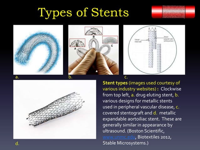 Ultrasound: Arterial Stent Complications by Ali Mian - Yale University ...