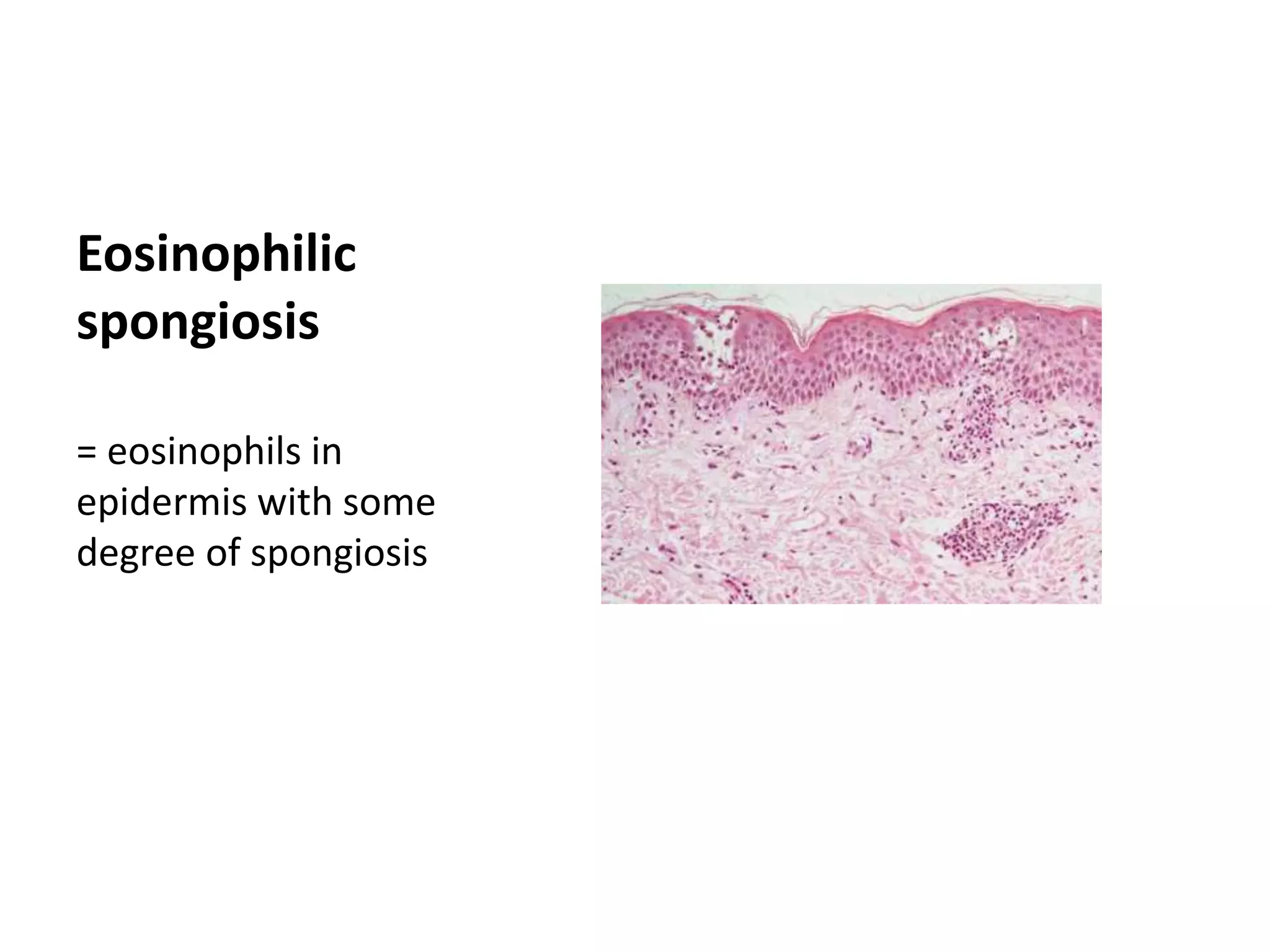 Interpretation of Pathology Reports in Biopsies for Dermatitis | PPTX