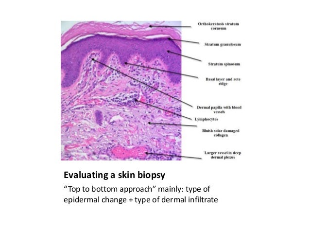 Interpretation of Pathology Reports in Biopsies for Dermatitis