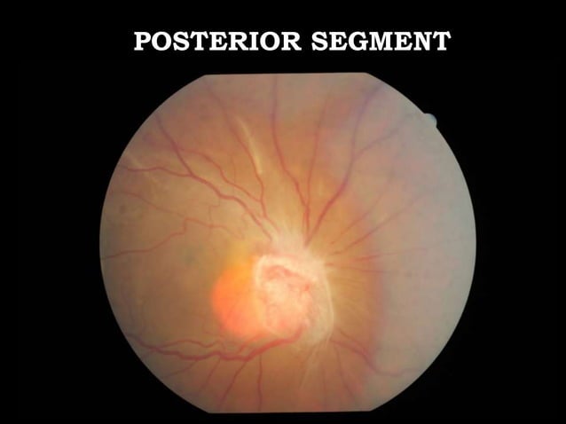 final VHL presentation.ppt | Eye and Vision Conditions | Diseases and ...