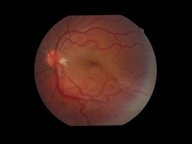 final VHL presentation.ppt | Eye and Vision Conditions | Diseases and ...