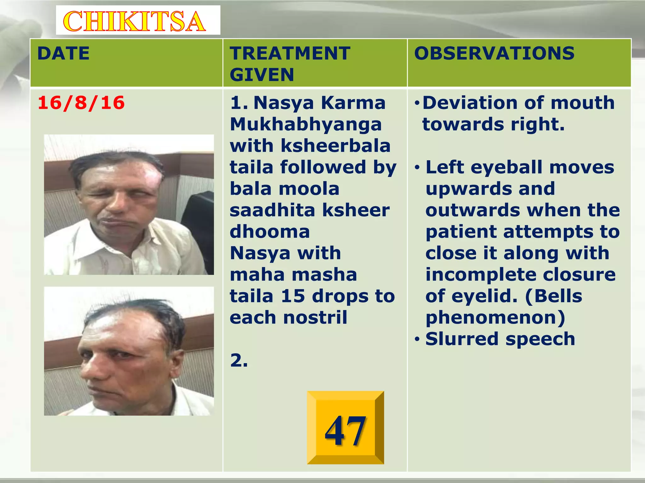 Ardita ( bells palsy ) case presentation | PPTX
