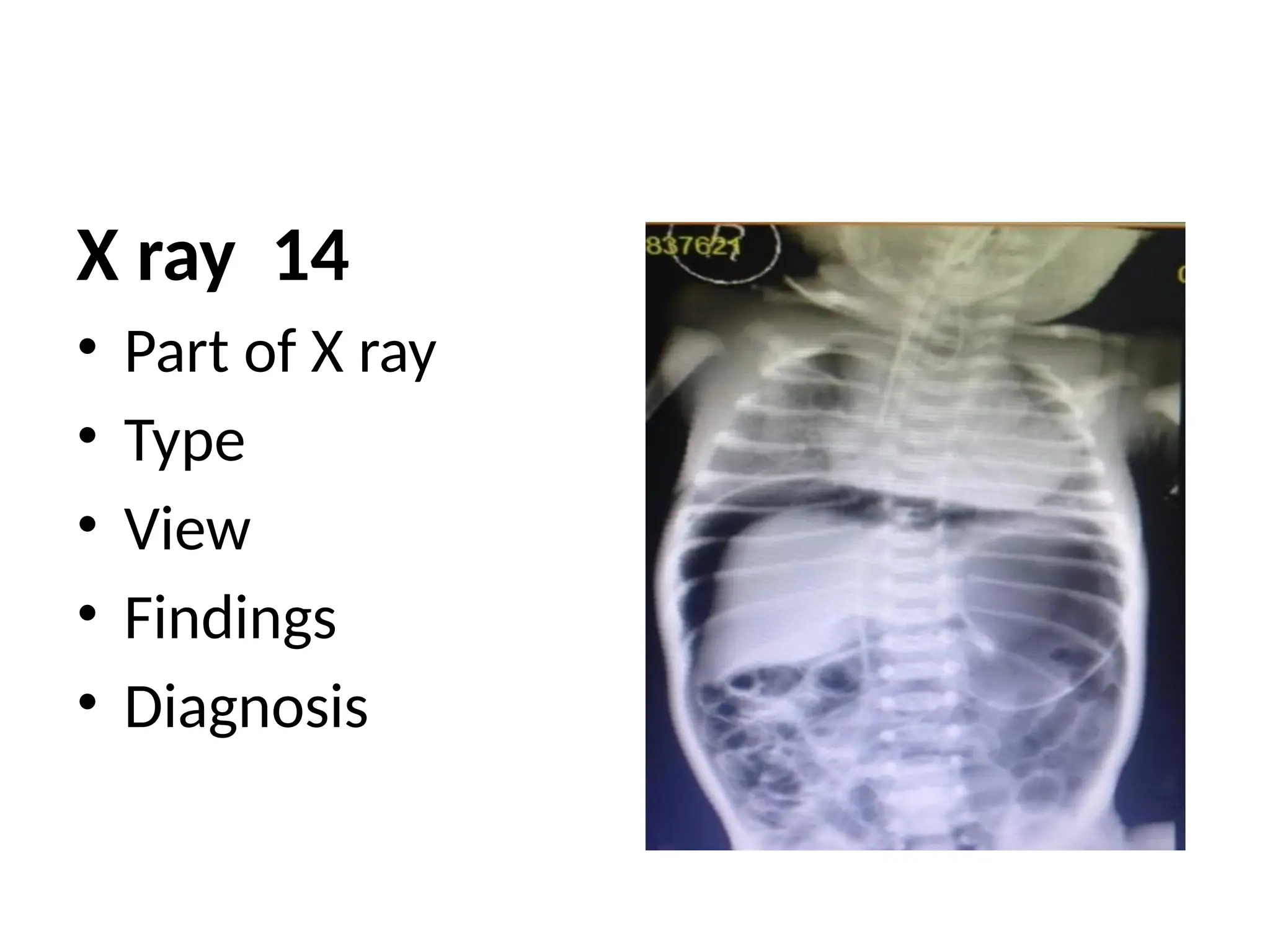 Awesome ppt on paediatric surgery x rays | PPT