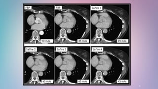 CT dose reduction | PPTX