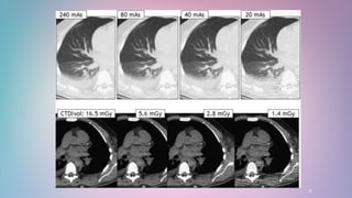 CT dose reduction | PPTX