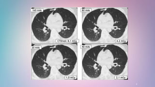 CT dose reduction | PPTX
