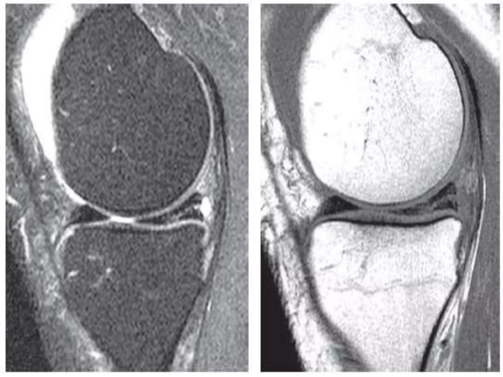 Findings of meniscal tears in mri knee | PPTX