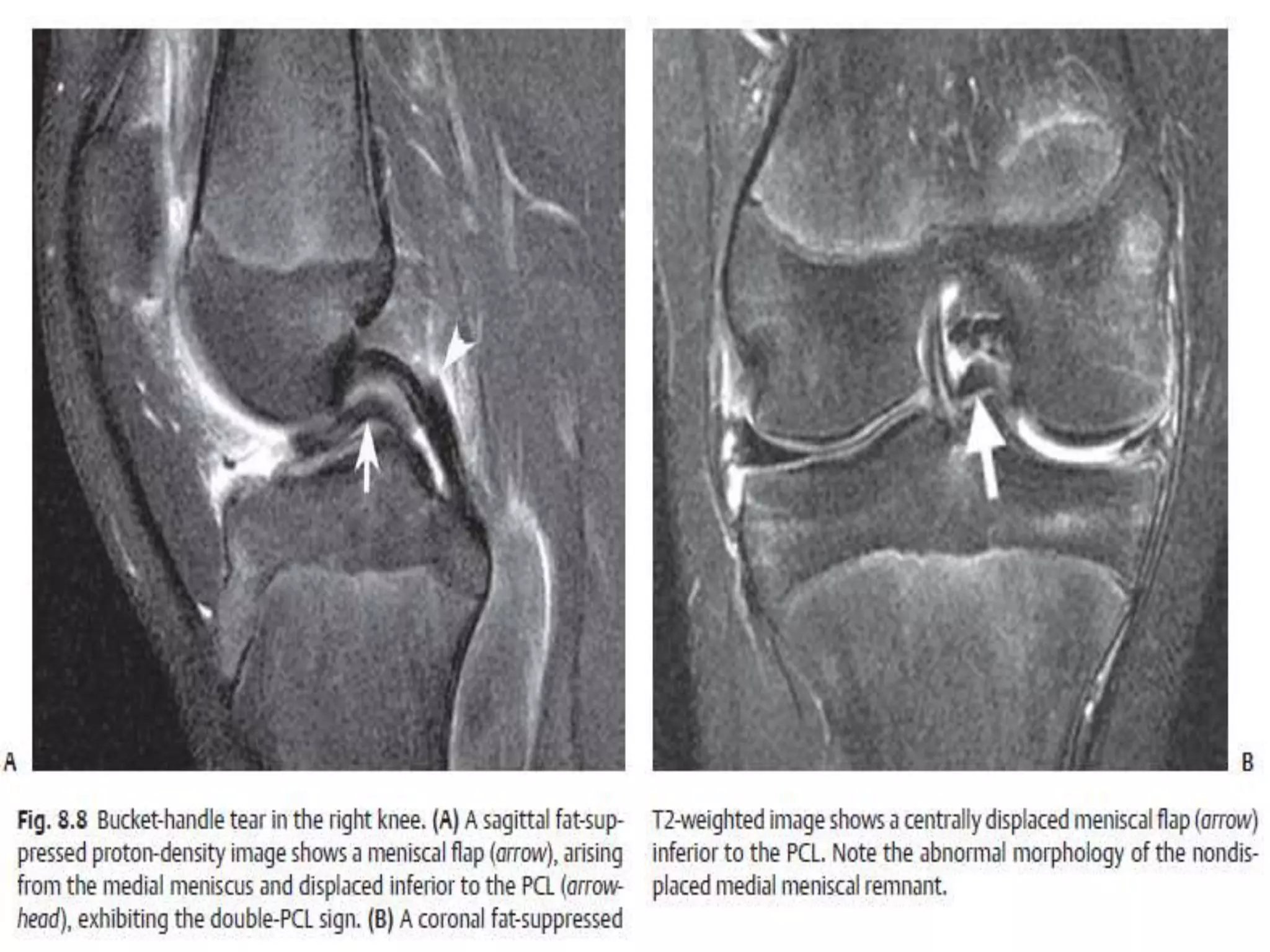 Findings of meniscal tears in mri knee | PPTX