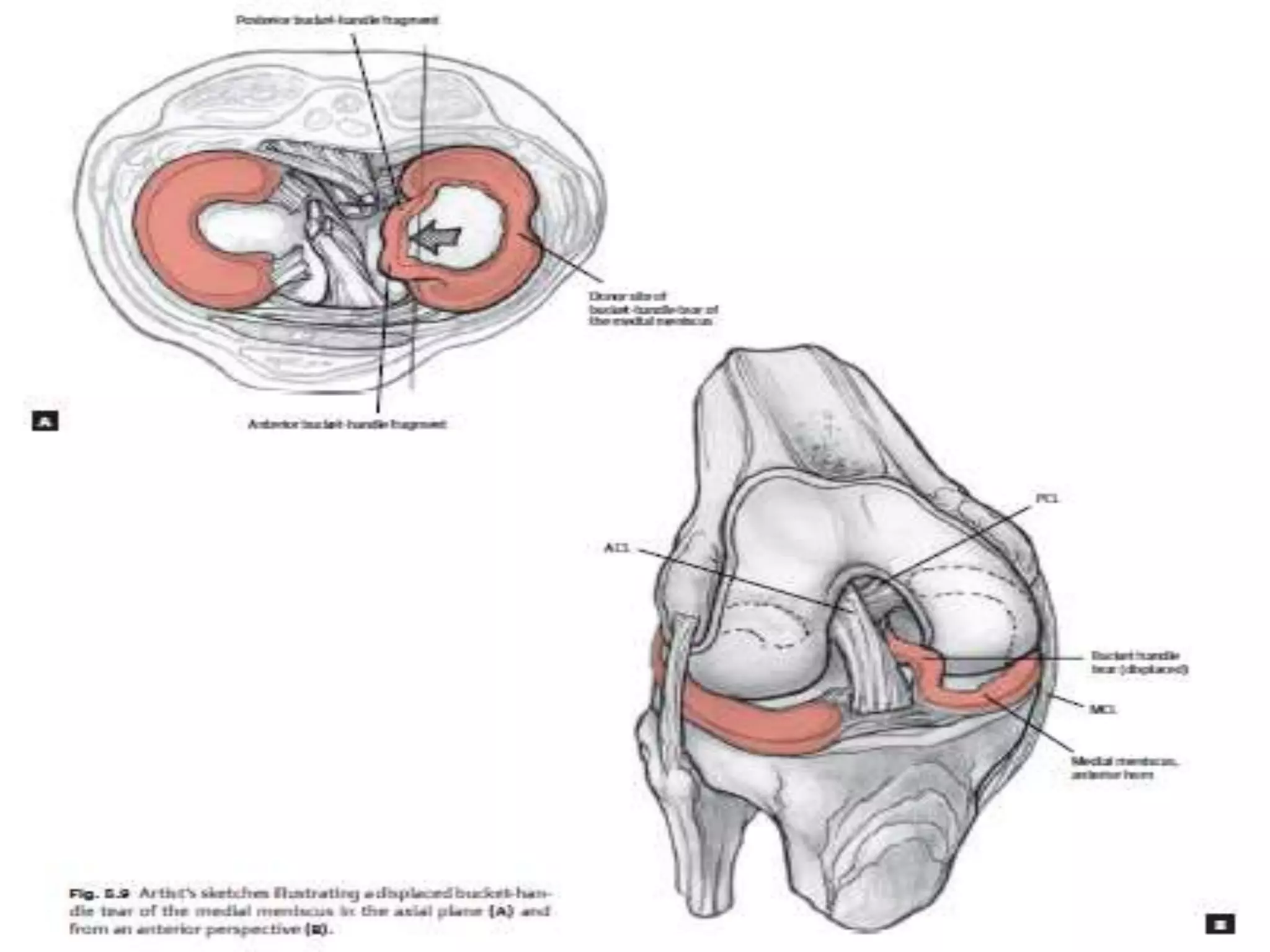 Findings of meniscal tears in mri knee | PPTX