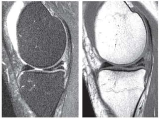 Findings of meniscal tears in mri knee | PPTX