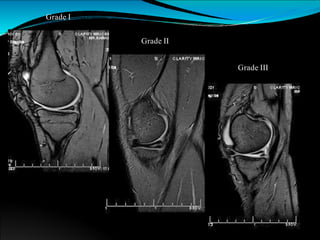 Findings of meniscal tears in mri knee | PPTX