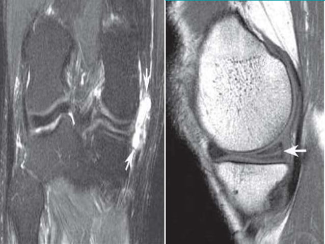 Findings of meniscal tears in mri knee | PPTX