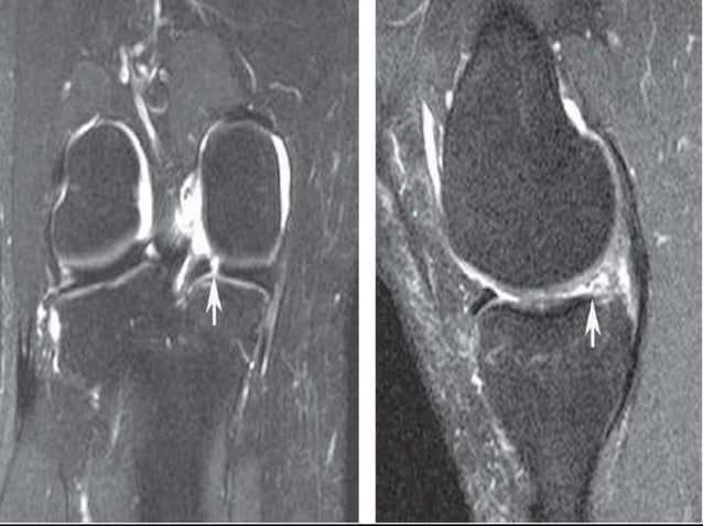 Findings of meniscal tears in mri knee | PPTX