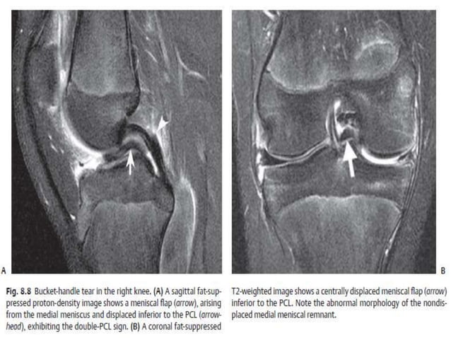 Findings of meniscal tears in mri knee | PPTX