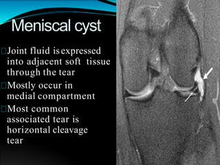 Findings of meniscal tears in mri knee | PPTX