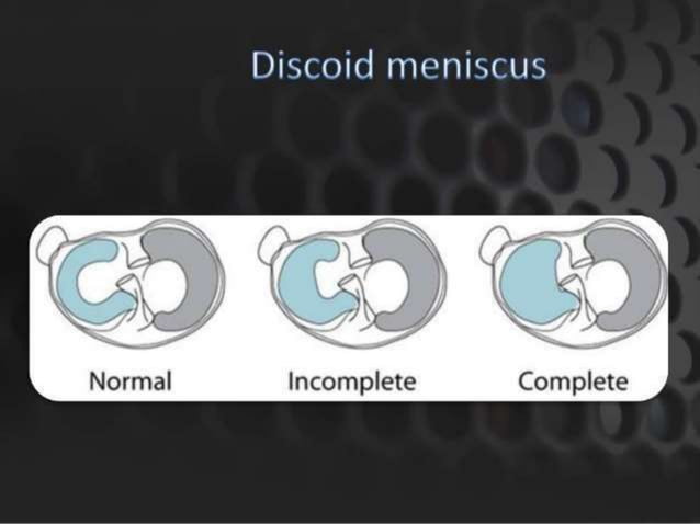Findings of meniscal tears in mri knee | PPTX