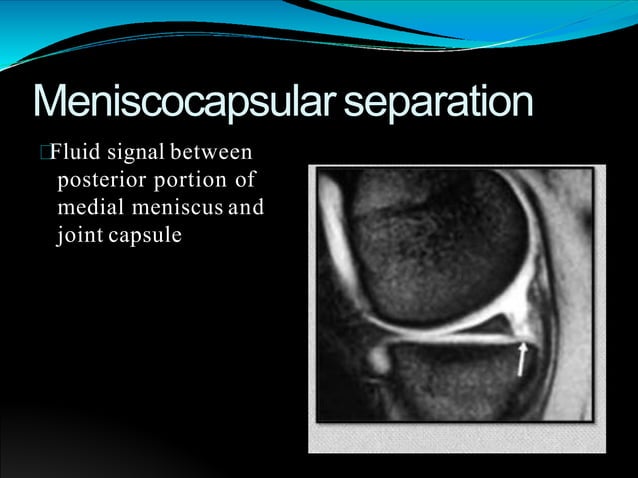 Findings of meniscal tears in mri knee | PPTX