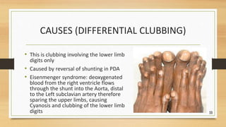 Finger Clubbing by Dr. Samuel2 Alawode.pptx