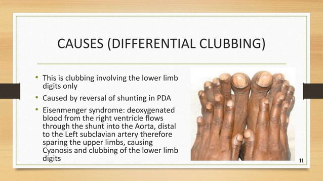 Finger Clubbing by Dr. Samuel2 Alawode.pptx | Lung and Respiratory ...