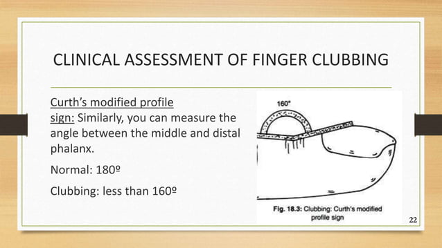 Finger Clubbing by Dr. Samuel2 Alawode.pptx | Lung and Respiratory ...