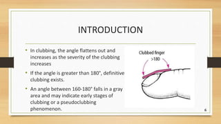 Finger Clubbing by Dr. Samuel2 Alawode.pptx