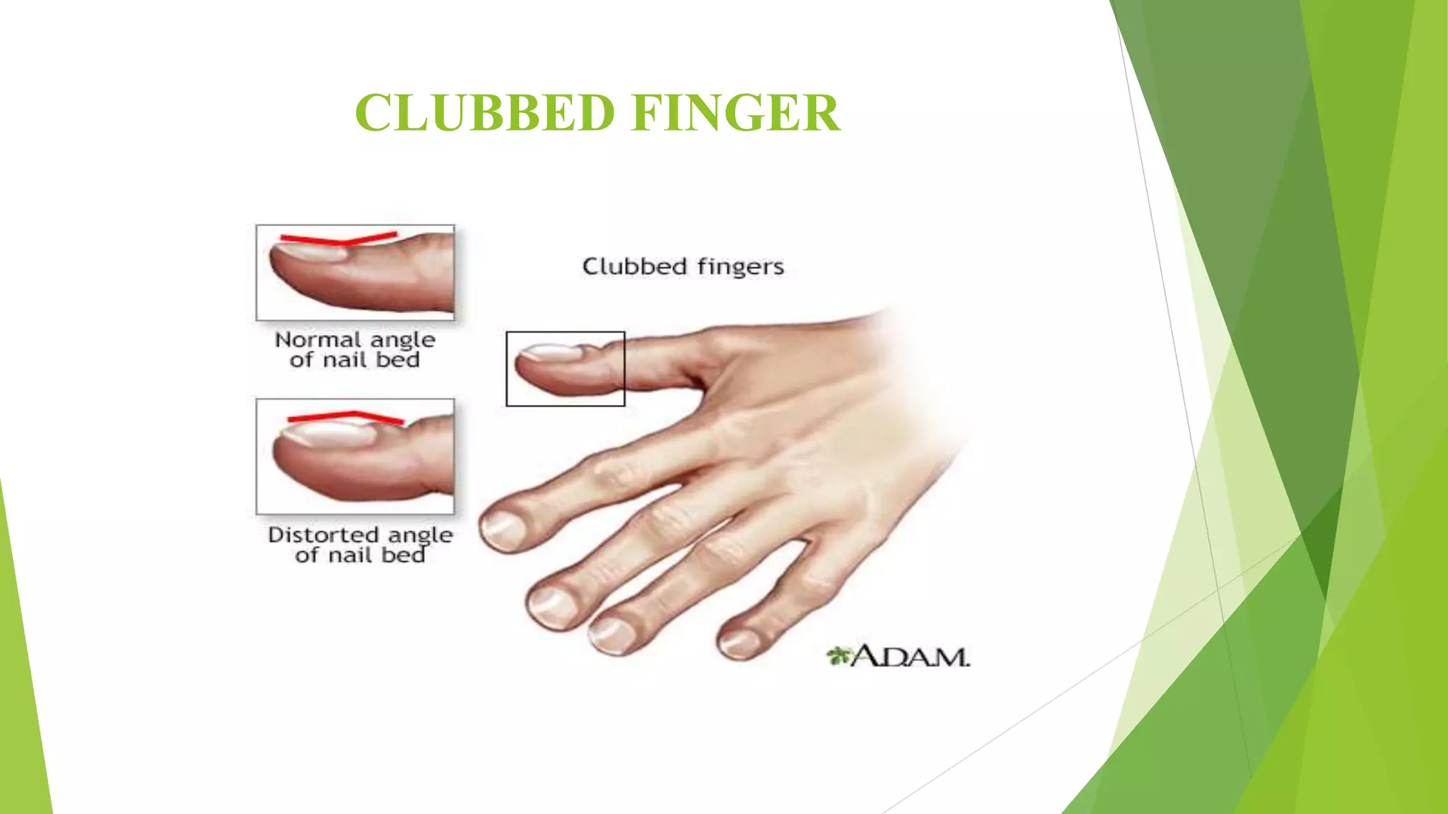 Finger clubbing, GCS Muscle Power Grading.pptx