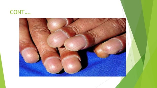 Finger clubbing, GCS Muscle Power Grading.pptx | Blood Disorders ...