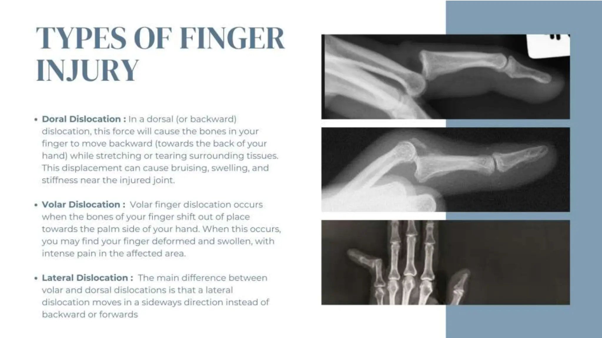 Finger Dislocation Exploring Your Best Treatment Options | PPTX