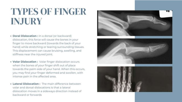 Finger Dislocation Exploring Your Best Treatment Options | PPTX