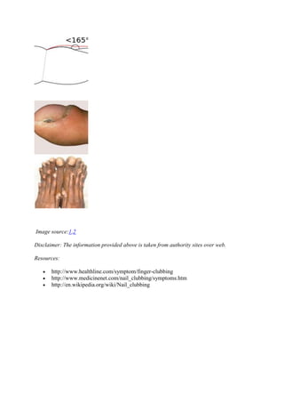 Fingernail clubbing causes | DOCX