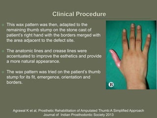 Finger prosthesis- Journal Club | PPTX