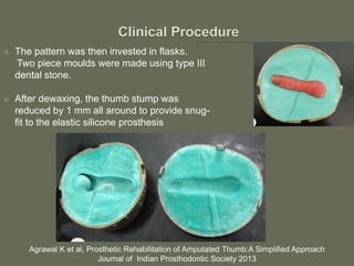 Finger prosthesis- Journal Club | PPTX