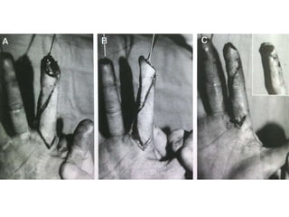 Finger tip injuries & management | PPTX