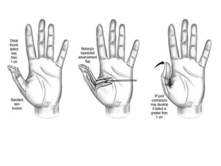 Finger tip injuries & management | PPTX