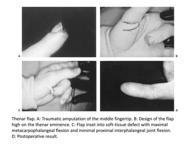 Finger tip injuries & management | PPTX | First Aid | Injuries