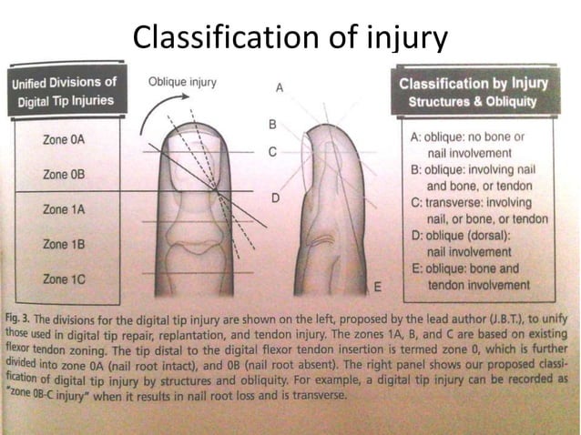 Classification of finger tip injuries by Vadrevu Rao