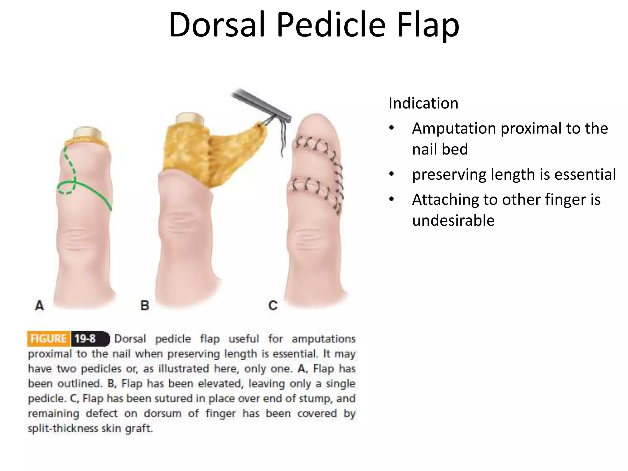 Finger tip injuries | PPTX