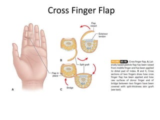 Finger tip injuries | PPTX | Death, Injury, or Military Conflict ...
