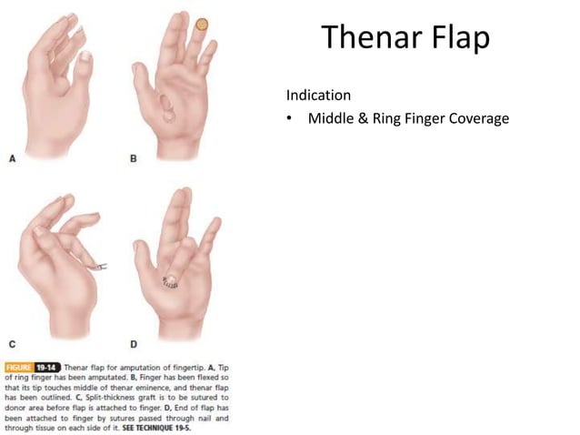 Finger tip injuries