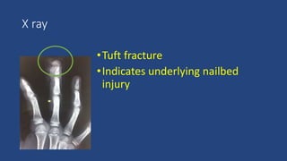 Finger tip injuries in children | PPTX