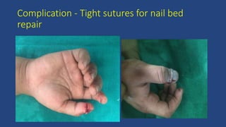 Finger tip injuries in children | PPTX