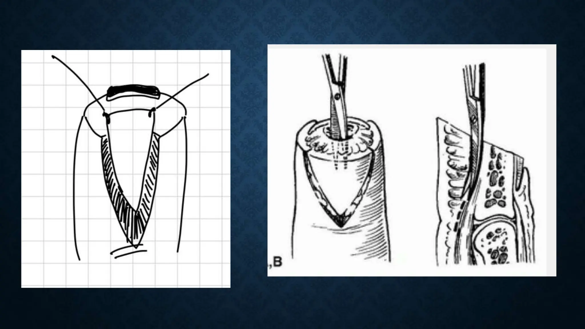 FINGER TIP INJURIES in hand ( plastic surgery).pptx