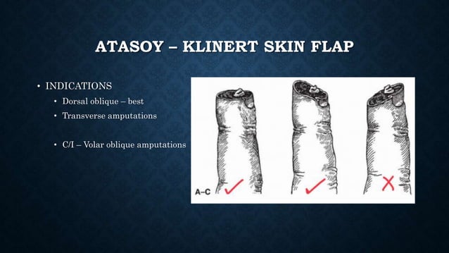 FINGER TIP INJURIES in hand ( plastic surgery).pptx