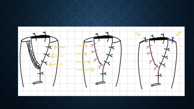 FINGER TIP INJURIES in hand ( plastic surgery).pptx