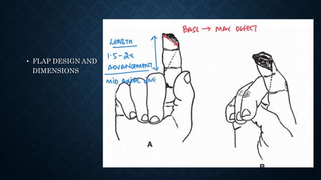 FINGER TIP INJURIES in hand ( plastic surgery).pptx