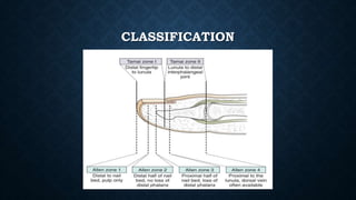 FINGER TIP INJURIES in hand ( plastic surgery).pptx